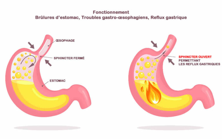 8 symptômes du reflux gastrique